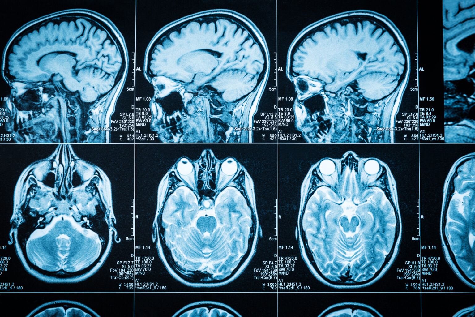 The Dark History Of The Lobotomy, Which Is Technically Still Legal In ...