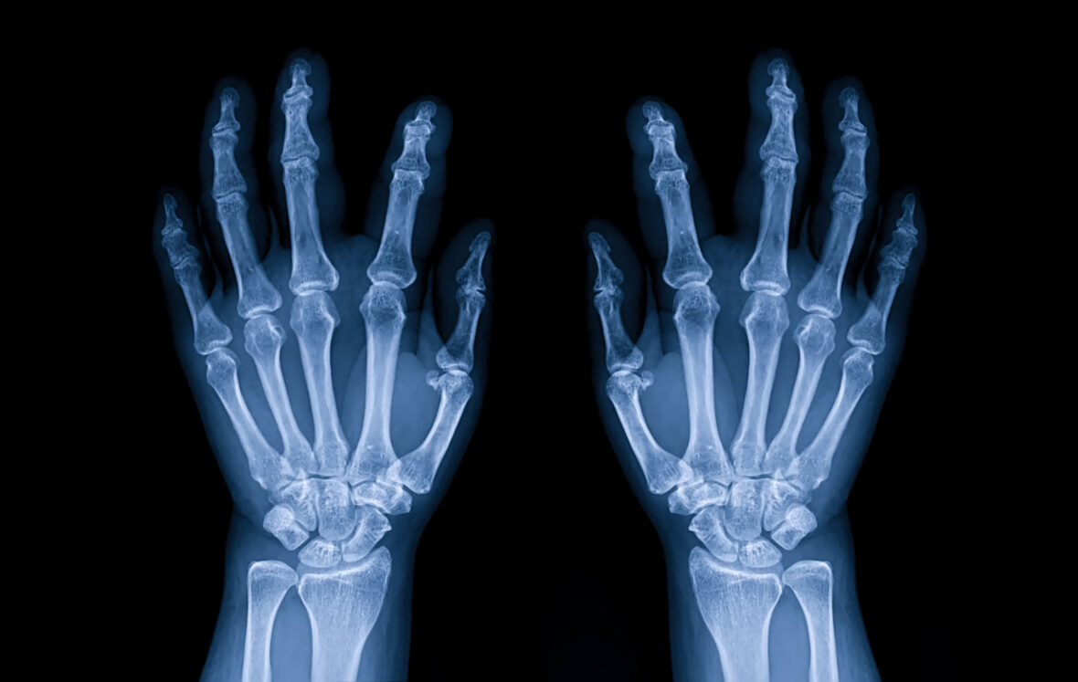 Stone Man Syndrome Is A Rare Disease That Turns Muscles Into Bones ...