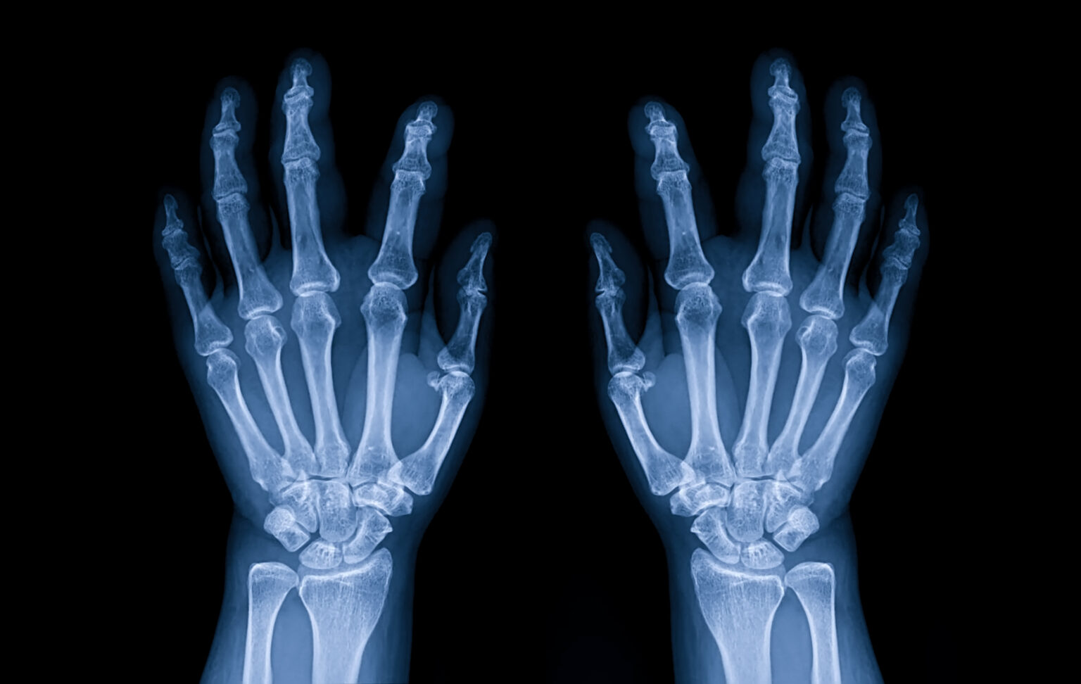 Stone Man Syndrome Is A Rare Disease That Turns Muscles Into Bones ...
