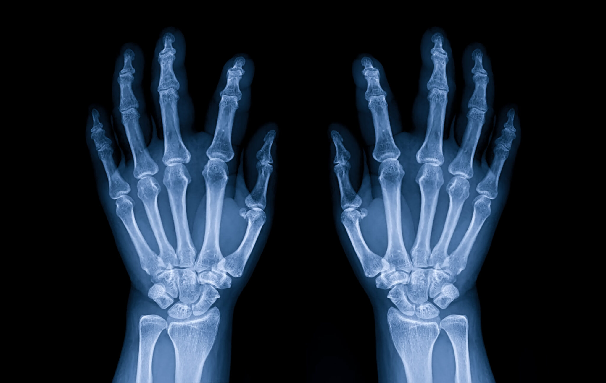 Stone Man Syndrome Is A Rare Disease That Turns Muscles Into Bones ...